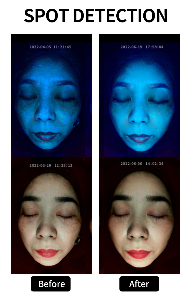 Skin Scanner Facial Skin Analyzer Skin Smart Diagnostic Device AI ...